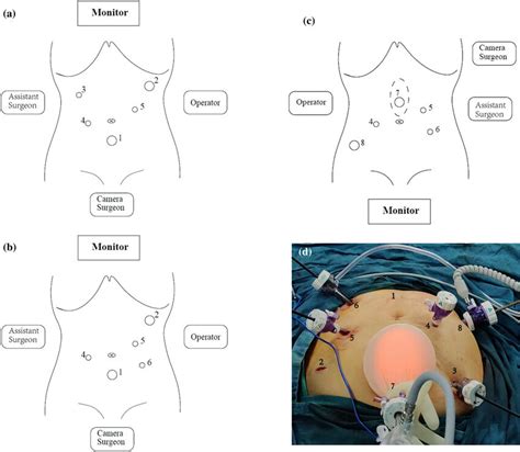 The Steps Of Laparoscopic Surgery For Synchronous Multiple Download Scientific Diagram