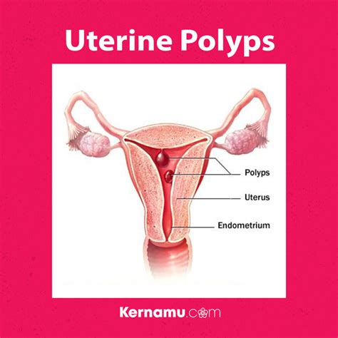 Kebanyakkan Wanita Yang Mempunyai Polyp Tidak Mempunyai Apa Apa Symptom Atau Tanda Polyp