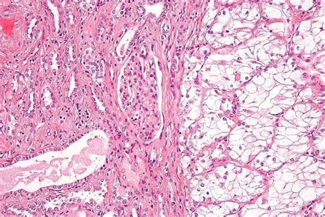 Renal Cell Carcinoma Alchetron The Free Social Encyclopedia