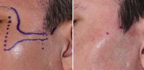 Technical Strategies Percutaneous Zygomatic Arch Osteotomy Technique