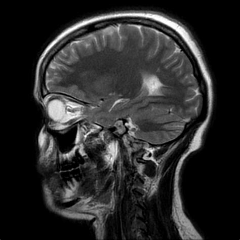 File High Grade Glioma NOS Grade Radiopaedia Sagittal NC Commons