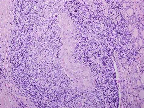 Pathology Outlines Diffuse Sclerosing