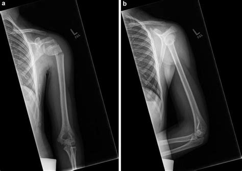 Proximal Humerus Fractures Obgyn Key