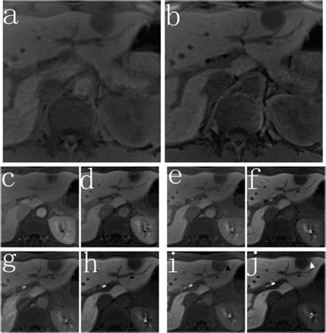 Images From A 37 Year Old Man With Hepatic Metastasis Of Colorectal