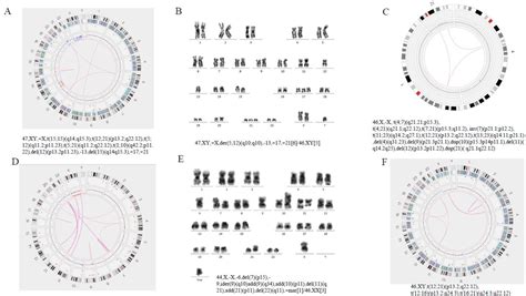 Figure 1 From Optical Genome Mapping For Comprehensive Assessment Of Chromosomal Aberrations And