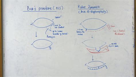 Ukm Ophthal Part 2 2010 Ectropion