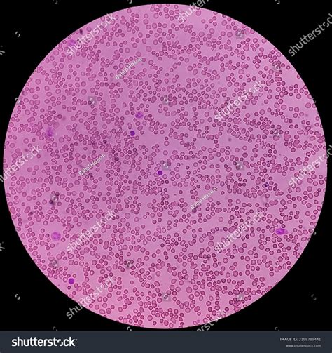 Blood Smear Show Target Cell Spherocytes Foto Stock 2198789441