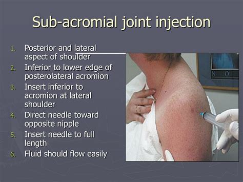 Ppt Steroid Joint Injections Powerpoint Presentation Free Download Id 85101