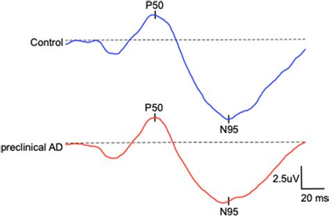 Depicts The Recorded Pattern Electroretinogram Responses In Download Scientific Diagram