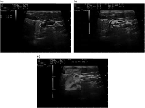 A The Isoechoic Solid Nodule 143 Â 82 Mm Possessing The Micro And