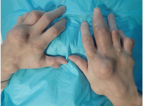 Subcutaneous Nodules