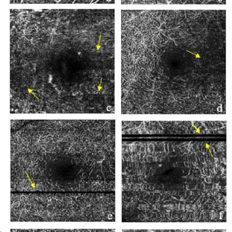 Examples Of Excluded Dcp Images During Quality Control Process