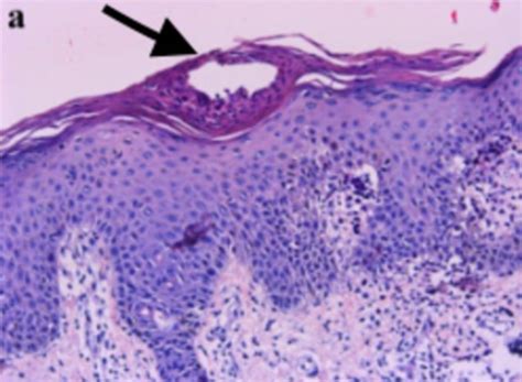 Microabscess Flashcards Quizlet
