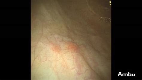 Evaluation And Bladder Neck Assessment With Ascope 5 Cysto Hd Using