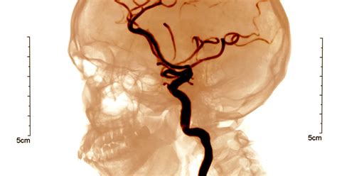 Symptomen Zo Voel Je Een Hersenbloeding Aankomen