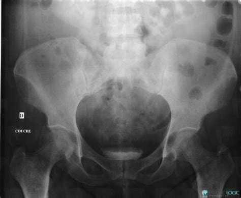 Radiology Case Mastocytosis X Rays Ct Diagnologic