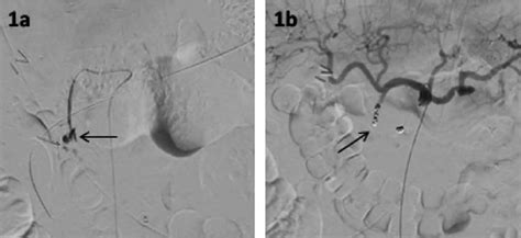 A Pseudoaneurysm Arrow Seen On Initial Angiogram At Our Download Scientific Diagram
