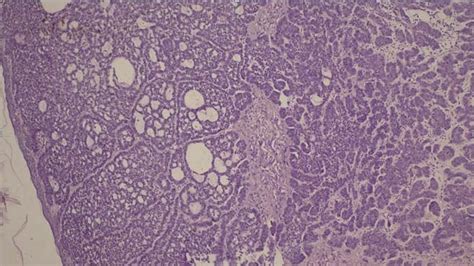 Microscopy Of Bcc With Sebaceous Differentiation Hande 100x