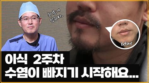 수염이식 2주차 환자의 최종결산 수염이식 질문 총집합했습니다 Youtube