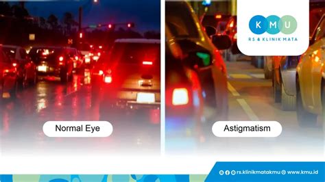 Mata Silinder Astigmatisme Gejala Penyebab And Pengobatan