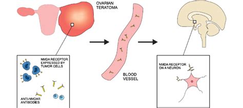 Nmda Receptor Nmdar Is Expressed On The Surface Of Ovarian Teratoma Download Scientific