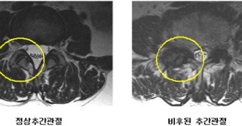 허리 뒤로 젖히면 아파요 허리통증의 비밀