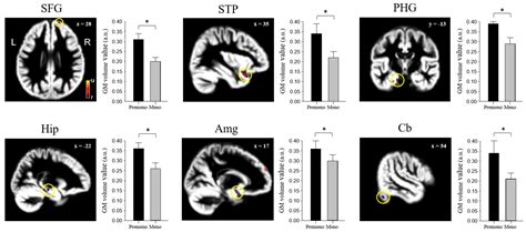 Altered Sexual Response Related Functional Connectivity And Morphometric Changes Influenced By
