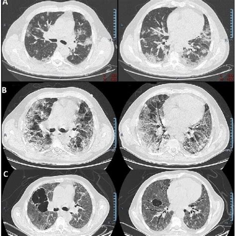 Thorax Ct Scan A At Admission Diffuse Consolidation In The Download Scientific Diagram