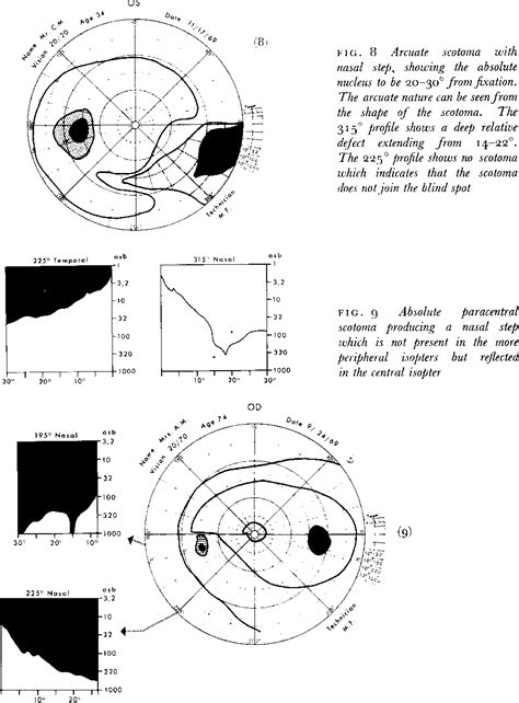 Figure 9 From The Glaucomatous Visual Field Semantic Scholar