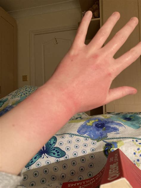 Rare Disease Day My Erythromelalgia Story Life Of Pippa