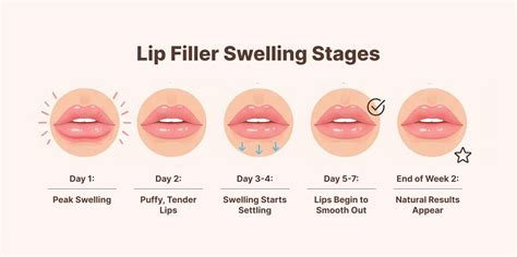 Lip Filler Swelling Stages Day By Day Healing Guide