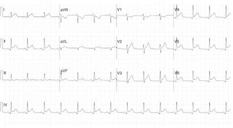 ECG Showing Diffuse Concave ST Elevation In All Leads With Download Scientific Diagram