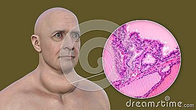 A Man With Enlarged Thyroid Gland D Illustration And Micrograph Toxic Goiter CartoonDealer