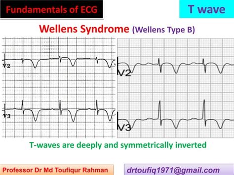 Approach To A Patient With T Wave Abnormality In Ecg Ppsx Heart And