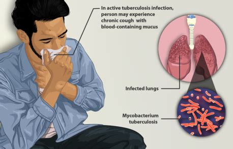 Tuberculosis Wikipedia