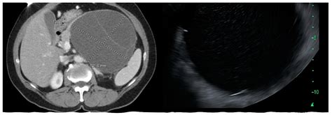 Diagnostics Free Full Text Diagnosis And Management Of Pancreatic