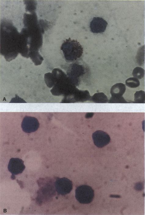 Eosinophiluria — A New Method Of Detection And Definition Of The