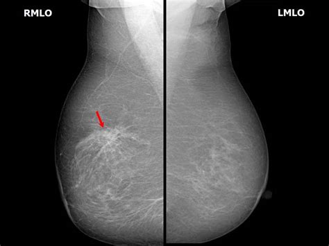 Atlas Of Breast Cancer Early Detection
