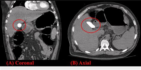 Figure 1 From Ct Imaging Findings Of Porcelain Gallbladder And Epiploic