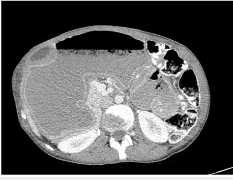 Ct Scan Showed Dilation Of The Stomach And Associated Compression Download Scientific Diagram