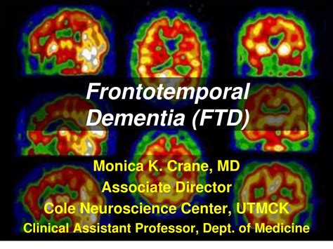 Ppt Frontotemporal Dementia Ftd Powerpoint Presentation Free Download Id 6392277