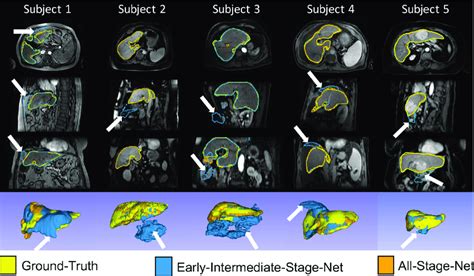 Examples Of The Superior Liver Segmentation Performance Of The Download Scientific Diagram