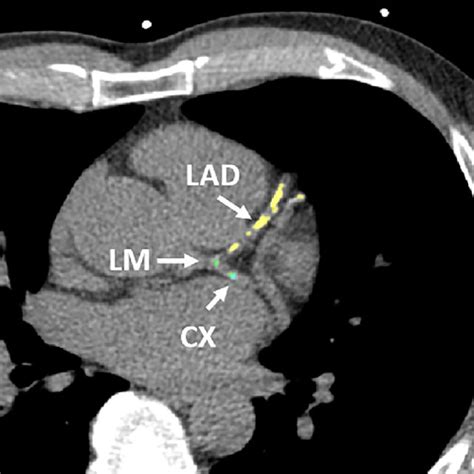 How Dangerous Is A High Calcium Score Monnie Raymond