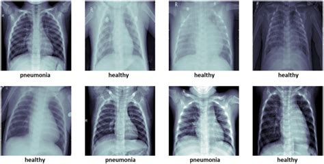 Detection Of Pneumonia Using Convolutional Neural Networks And Deep