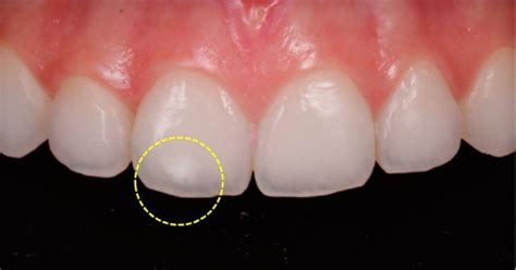 치아 표면의 흰색 반점 왜 생긴 걸까