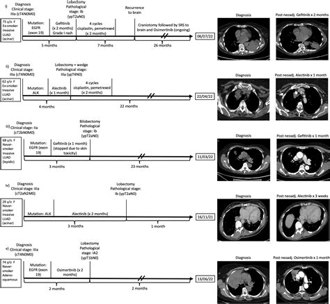 Neoadjuvant Targeted Therapy In Nonsmall Cell Lung Cancer And Its Impact On Surgical Outcomes