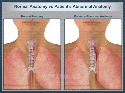 Normal Anatomy Vs Patients Abnormal Anatomy Trialquest Inc