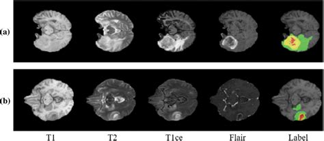 Brain Tumor Segmentation Through Level Based Learning Model