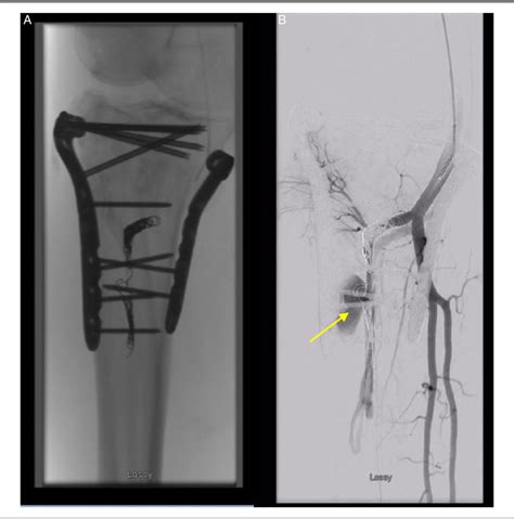Figure 2 From Successful Coil Embolization Of A Large Anterior Tibial Artery Pseudoaneurysm