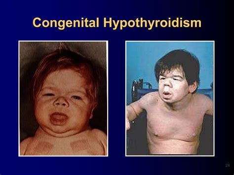Thyroid Disorders Hyperthyroidism And Hypothyroidism Pdf